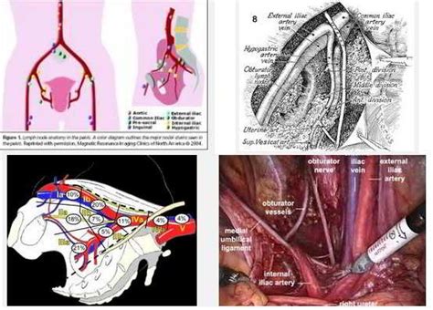 World Laparoscopy Hospital Frequently Asked Questions About Pelvic Lymph Node Resection