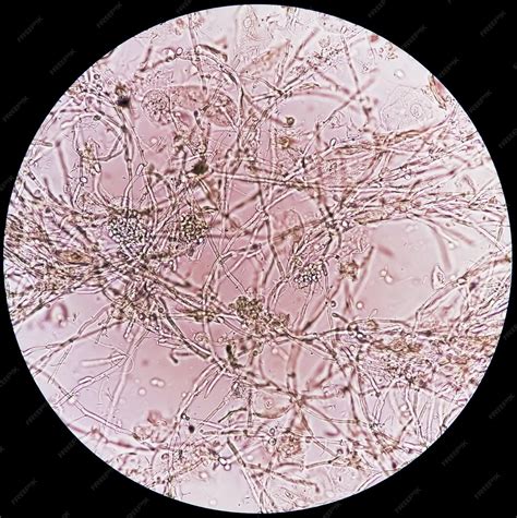 Premium Photo Pseudohyphae And Budding Yeast Cells In Patient Urine
