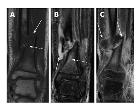 Role Of Mri In The Diagnosis And Treatment Of Osteomyelitis In Pediatric Patients