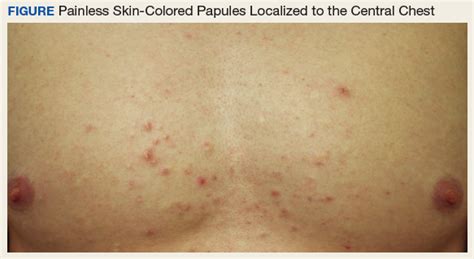 Skin Colored Papules On The Chest Mdedge