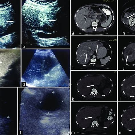 Radiological And Cytological Findings In Focal Hepatic Lesions Download Scientific Diagram