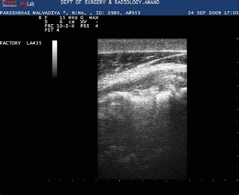Ultrasonogram Showing An Echogenic Posterior Shadowing Non Anatomic Download Scientific