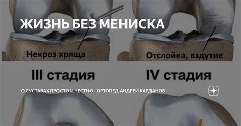 ЖИЗНЬ БЕЗ МЕНИСКА О СУСТАВАХ ПРОСТО И ЧЕСТНО ортопед Андрей Карданов Дзен