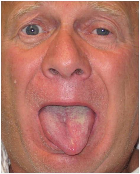 Tongue Deviation Stroke Functional Neurological Disorder Tfjcfz