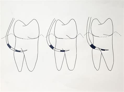 Saving Teeth Revisiting Molar Furcation Treatment With Advanced