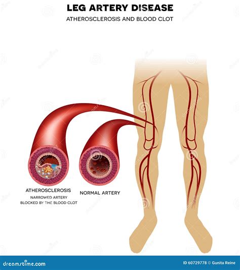 Atherosclerosis Fibrous Plaque Formation Vector 64108274