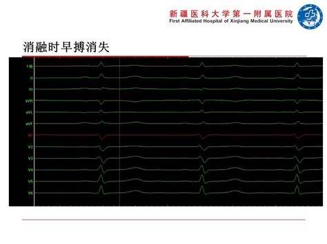 参赛病例36 李耀东山重水复疑无路柳暗花明又一村流出道室早消融一例 严道脑血管网