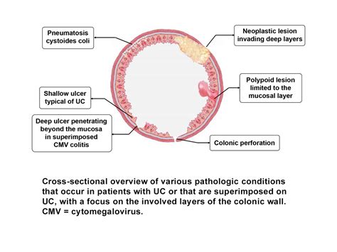 Is Enterography Underutilized In Diagnosing Ulcerative Colitis