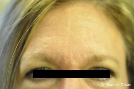 Frown Lines Before After Gallery