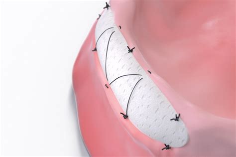 Presentation Of A Modified Method Of Vestibuloplasty With An Early