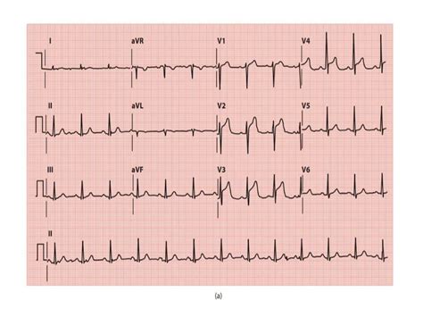St Segment In Ecgst Elevation And St Depression Pptx