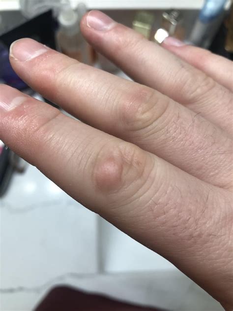 Weird Bumps On Most Of My Knuckles Rdermatology