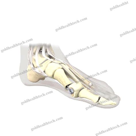 Hallux Valgus Osteotomy Screw Gold Health Tech
