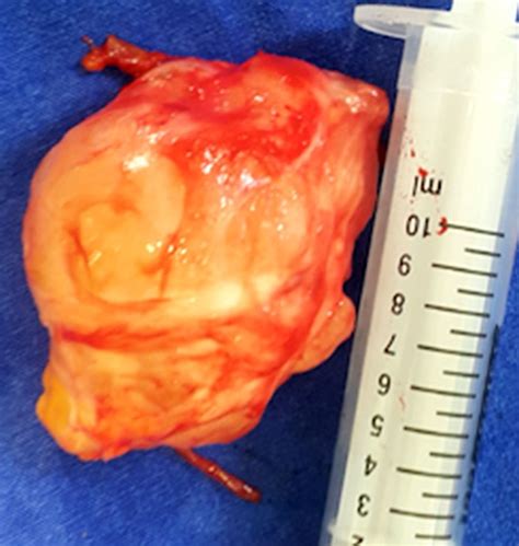 The Lesion After Local Excision Download Scientific Diagram