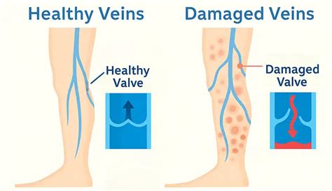 Stasis Dermatitis Treatment That Works When Others Fail Harlanmd