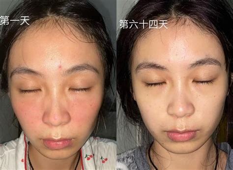 李佳琦说的敏感肌护理方法太绝了！脸上泛红敏感、干痒刺挠、反复爆痘、屏障受损有红血丝等敏感肌烦恼通通解决了！想要养成 厚脸皮”的敏感肌直接闭眼冲