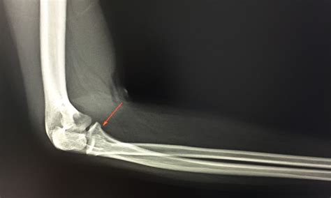 Elbow Radial Head Or Neck Fracture Nhs Inform