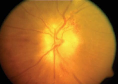 Resolving Optic Disc Oedema After 1 Week Of Treatment Download