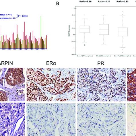 Sharpin Is Higher Expressed In Breast Tumor Correlates With Er α