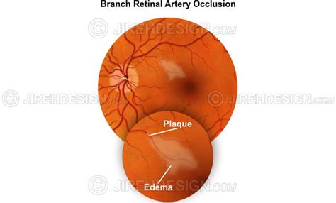 Brao Branch Retinal Artery Occlusion Co0101 Stock Eye Images
