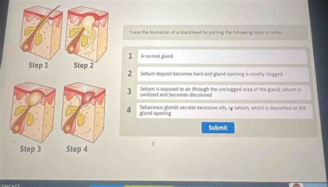 Solved Trace The Formation Of A Blackhead By Putting The Following