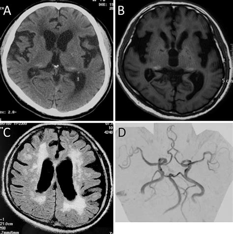 Figurea Ct Of The Brain Shows High Density Lesions In The Bilateral