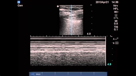 Ultrasound Diagnosis Of Pneumothorax Youtube
