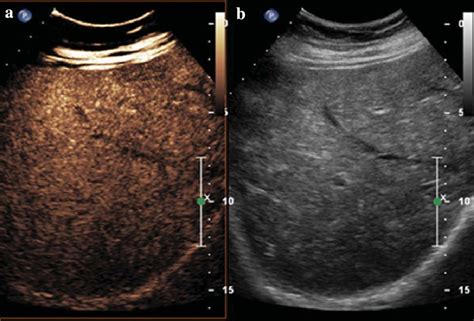 Hepatic Nodular Steatosis Ceus Image A Shows Homogenous Enhacement
