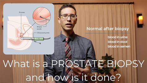Michael Woo Mba Ccs On Linkedin Prostate Biopsy Procedure Explained