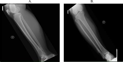 Figure 1 From Distal Fibular Excision A Review Of The Literature And