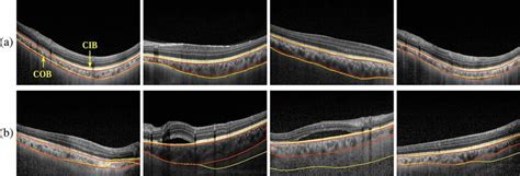 choroid boundary cib and cob detection on oct images via both