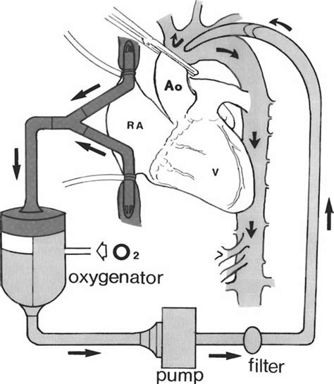 Cardiopulmonary Bypass Cannulation
