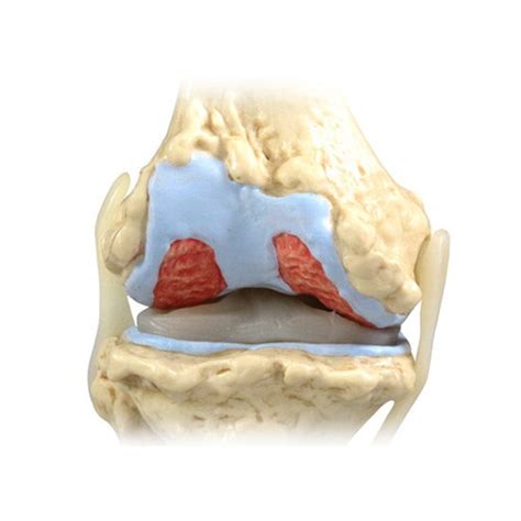 Shoulder Osteoarthritis 4 Stage Model Clinical Charts And Supplies