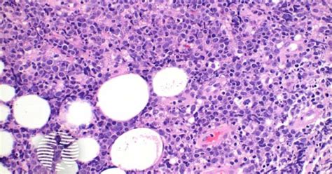 Primary Cutaneous Diffuse Large B Cell Lymphoma Pathology Image