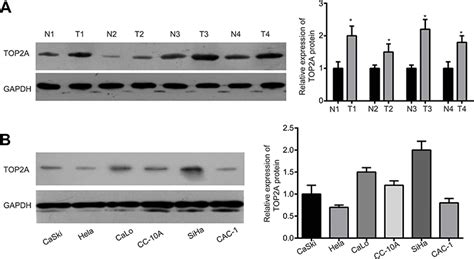 Top2a Promotes Cell Migration Invasion And Epithelial Mesenchym Cmar