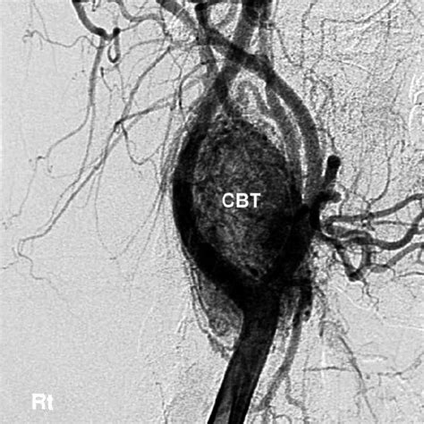 Duplex Ultrasound Longitudinal View Carotid Body Tumour At Carotid