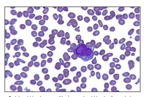 Propath On Linkedin Erythroleukemia A Case Report Propath Pathology Hematology…