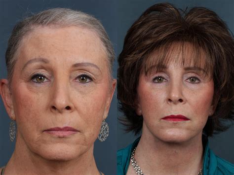 Blepharoplasty