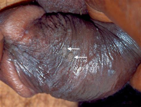 Core Concepts Sexually Transmitted Infections Co Occurring