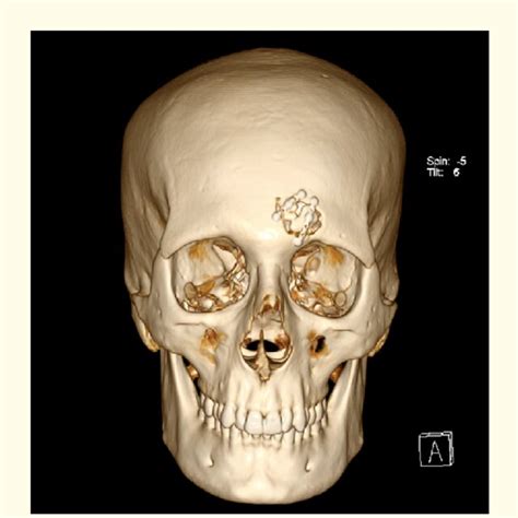 3d Scan Of The Left Frontal Bone Fracture Download Scientific Diagram