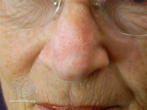 Actinic Keratoses Affecting The Face Dermnet Nz Lesions Ak Face Nc