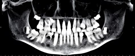 Missense Mutation In The Lrp5 Receptor Orr