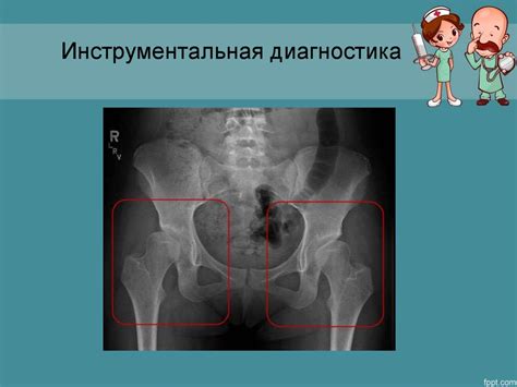 Дисплазии тазобедренных суставов презентация онлайн