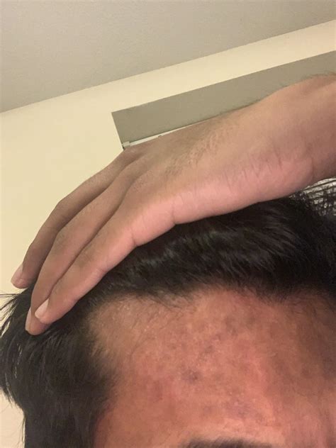 19 And Wondering How Bad Im Balding Rbalding