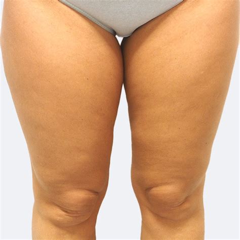 Photo And Video Beforeafter Tumescent Liposuction Medicom Clinic