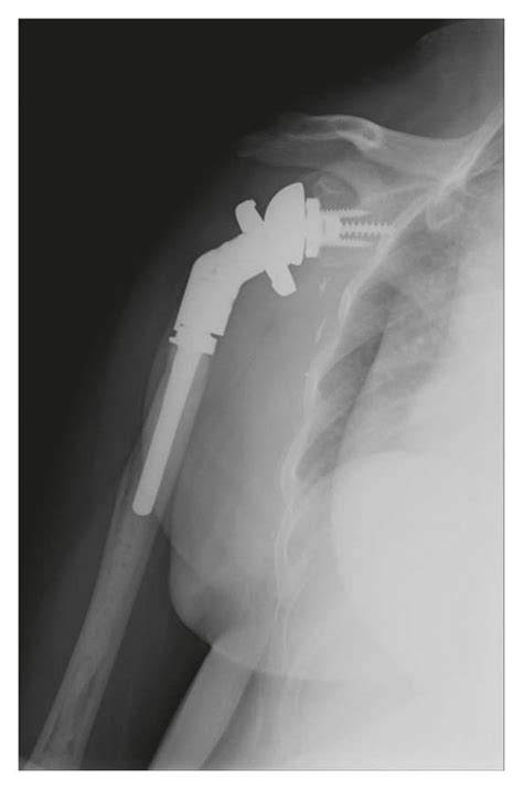 Reverse Shoulder Megaprosthesis Implanted In Our Institution After Download Scientific Diagram