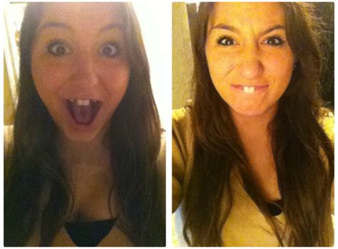 I Was Really Excited For My Incisor Adult Teeth To Grow In After I Lost