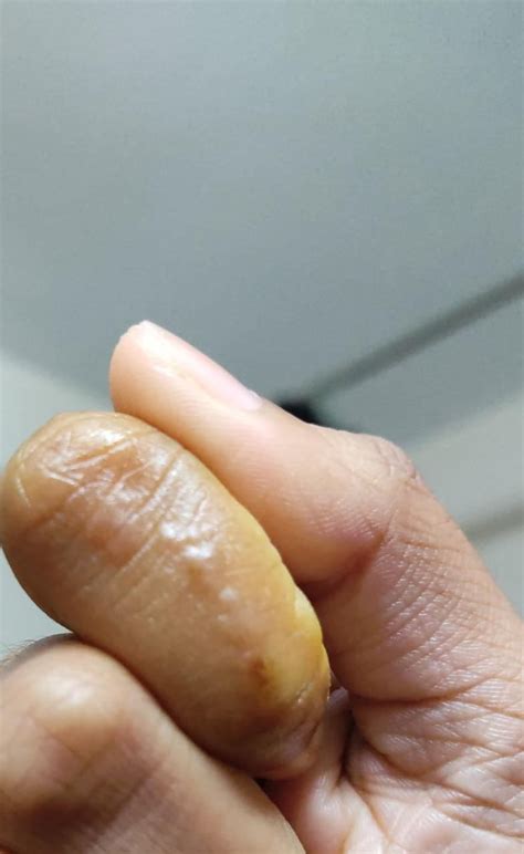 Itchy Blisters Rash Rdermatologyquestions