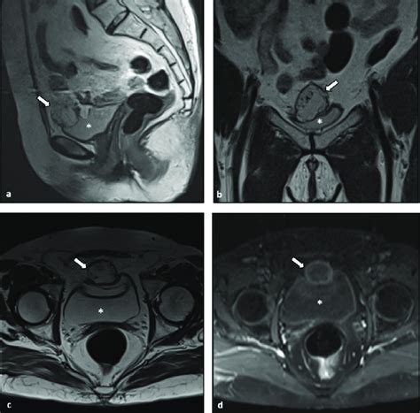 In The Anterior Segment Of The Bladder A Nodular Lesion Arrows With