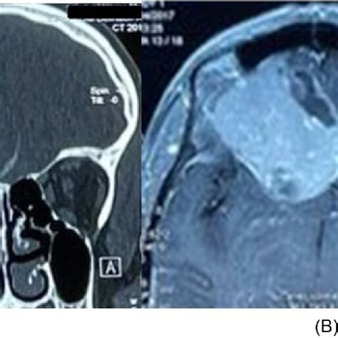 Ct Scan A And Mri B Show An Orbital Ossifying Fibroma Download Scientific Diagram